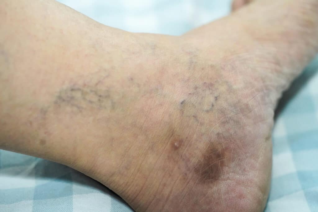 Discolored Skin Rash Naperville - Vein Discoloration Wheaton